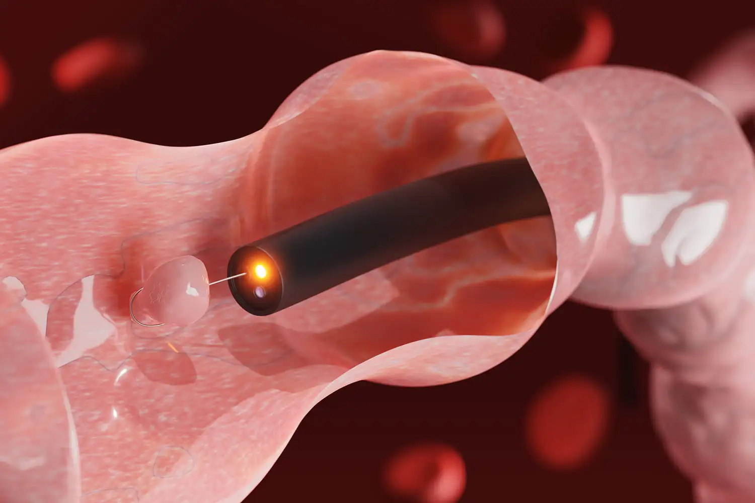 What Is Endoscopy Why It Is Done Shivaay Gastro Centre Dr Amit 0689